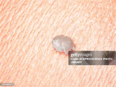 Scabies Mites Photos And Premium High Res Pictures Getty Images
