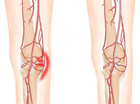 Genicular Artery Embolization Gae Procedures Vascular Ohio