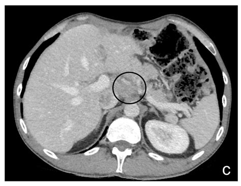 Peritoneal Carcinosis What The Radiologist Needs To Know