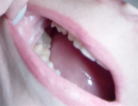 Что это может быть С внутренней стороны щёк белые полосы которые явно Medaboutme