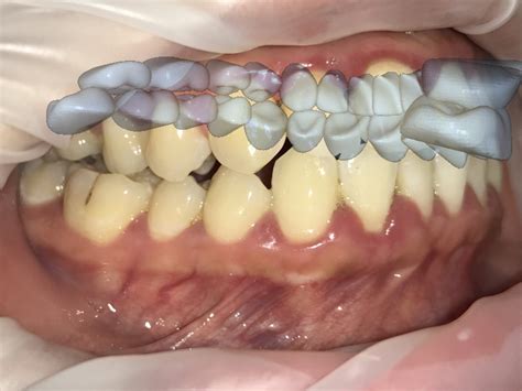 Wrong Visualization Results Issue 3 SJTUzhou 3D Teeth