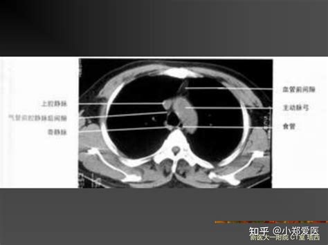 从0到1带你学会读ct片之呼吸系统影像学诊断（科普） 知乎