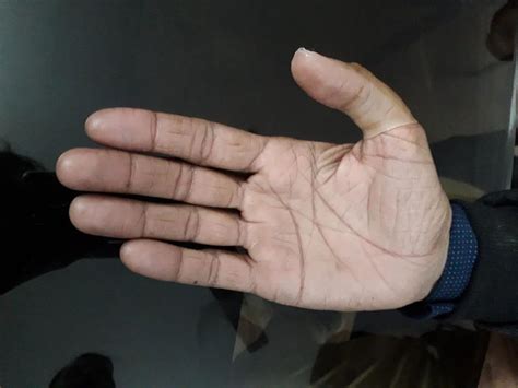 Rebuilt Silicone Thumb Prosthesis Below The Elbow At ₹ 5999piece In