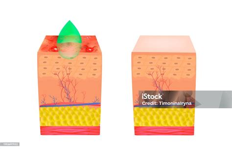 여드름에 대한 박리 염증이 있는 피부 여드름 여드름 화농성 피부의 해부학 적 구조 인포 그래픽 격리된 배경에 대한 벡터 그림입니다 각질제거에 대한 스톡 벡터 아트 및 기타