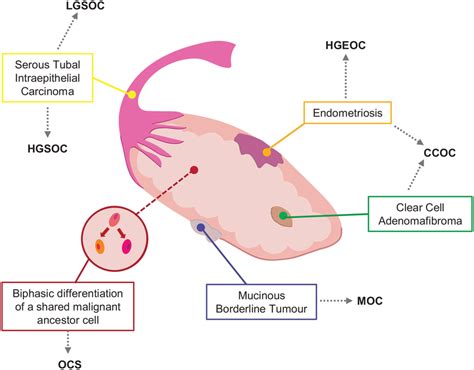 The Genesis Of Different Epithelial Ovarian Cancer Histologies Download Scientific Diagram