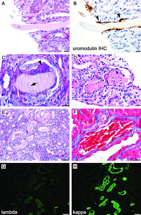 Morphologic Spectrum Of Light Chain Casts A Pas Pale Glassy Light