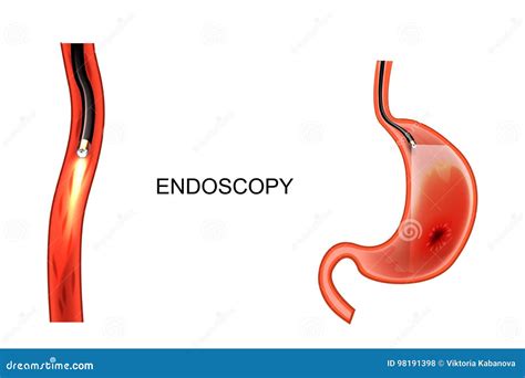 Endoscopy Stomach Ulcer Symptoms At Gregorio Fields Blog