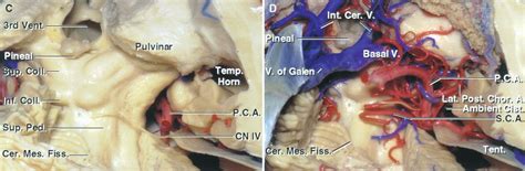 Tectal Plate Ars Neurochirurgica