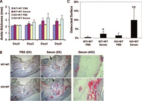 Osteoclastogenesis And Bone Erosion In Inflammatory Arthritis Are