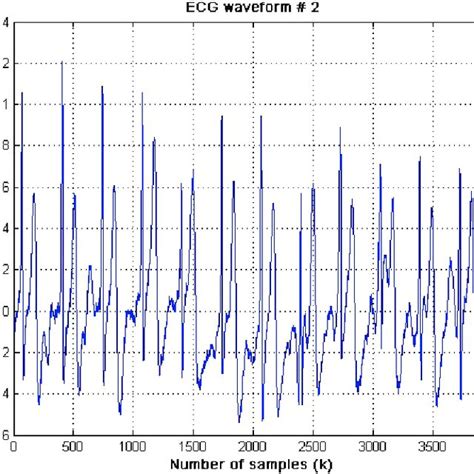Motion Artifacts On Ecg Input Signal From A Healthy Male Walking 18 Download Scientific Diagram