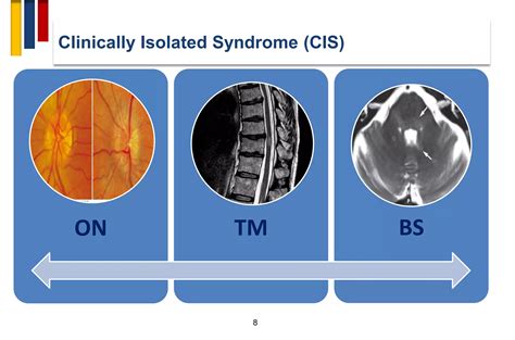 Clinically Isolated Syndromes Pdf