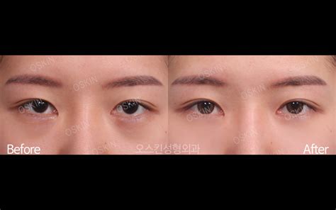 전후사진 23 페이지 오스킨성형외과 뷰티에이징의 중심 눈밑지방재배치 상하안검 리프팅