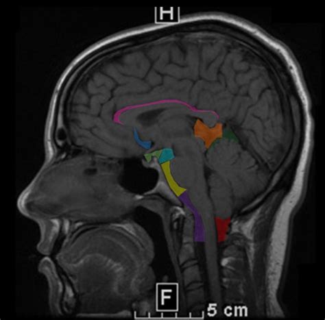 Subarachnoid Cisterns Of The Brain Flashcards Quizlet