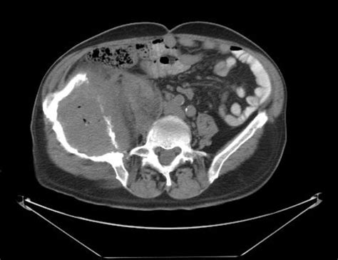 Ct Gas Locules Within The Pseudotumour Secondary To Percutaneous