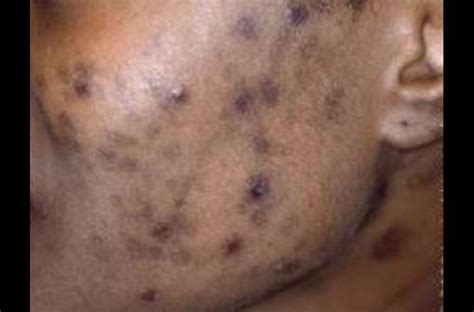 Natural Ways To Remove Black Spots At Home Adomonline Com