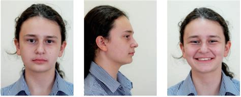 Trueease Fixed Bite Corrector — A Non Extraction Option