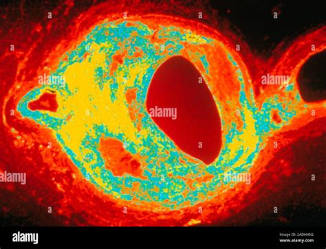 Digitised Light Micrograph Of A Cross Section Through An Atheroma