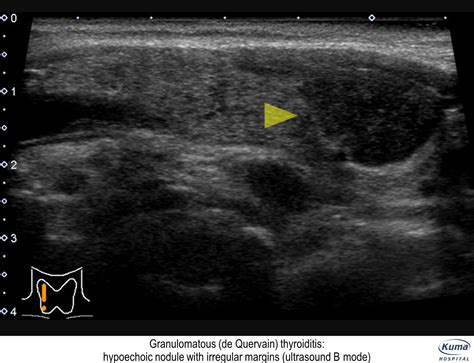Pathology Outlines Benign