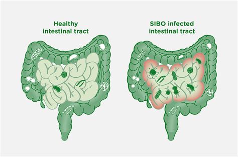 Sibo How Small Intestinal Bacterial Overgrowth Impacts The Microbiome