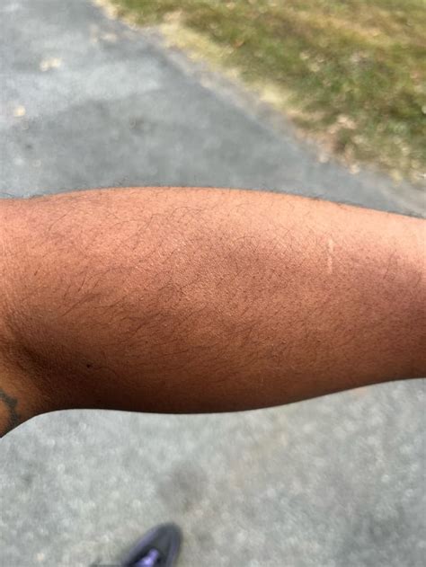 Small Bumps On Forearms Can Someone Please Help Im Having Anxiety About Possibly Sti