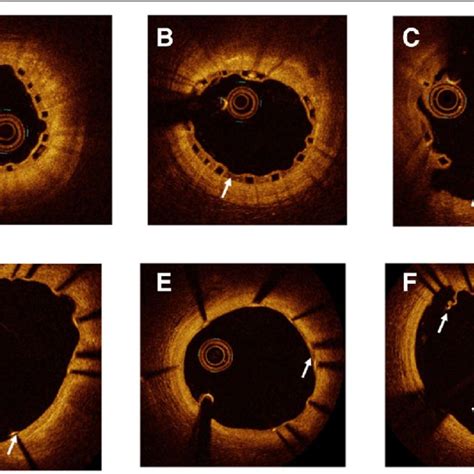 Qualitative Oct Findings At 3 Month Follow Up A Homogeneous Neointima