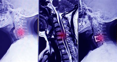 Unveiling Rarity Horner Syndrome Caused By Cervical Disc Herniation