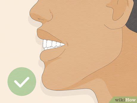 7 Ways To Fix An Overbite WikiHow
