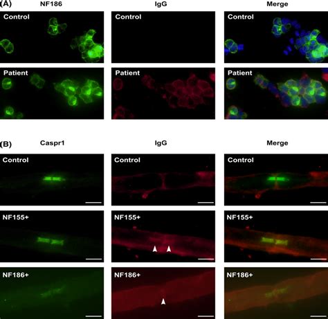 Example Of Cell‐based Assay And Teased‐fiber Assay Of Anti‐neurofascin