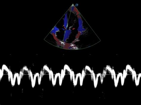 Trolley Cardiac Color Doppler Ultrasound Systems From China Manufacturer Dawei Medical
