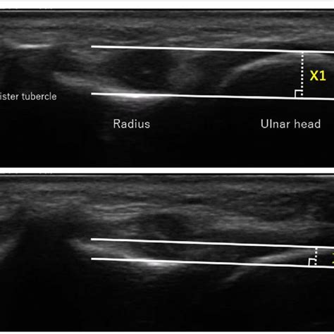 The Ultrasonography Of The Distal Radioulnar Joint A Before The
