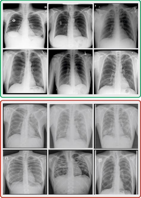 Figure From Robust Tuberculosis Detection Using Optimal Deep Learning Model Using Chest X Rays