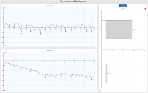 Visualeyes™ Spontaneous Nystagmus Interacoustics