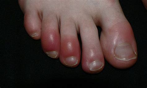 Chilblains Skin Condition Contour Dermatology