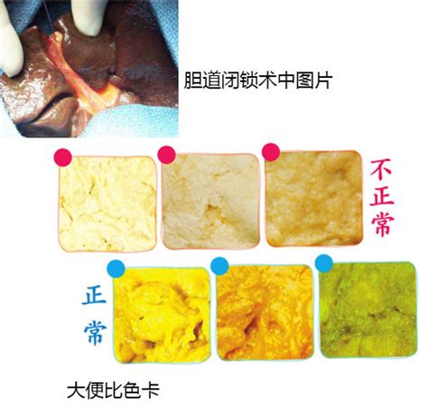 柏油样便图片识别怎样断柏油样胃柏油样图片第7页大山谷图库