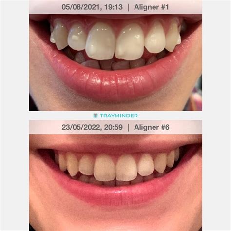 Progress 18 Initial Trays And 6 Refinement Trays 10 Months Ive Just Scanned For A Few More