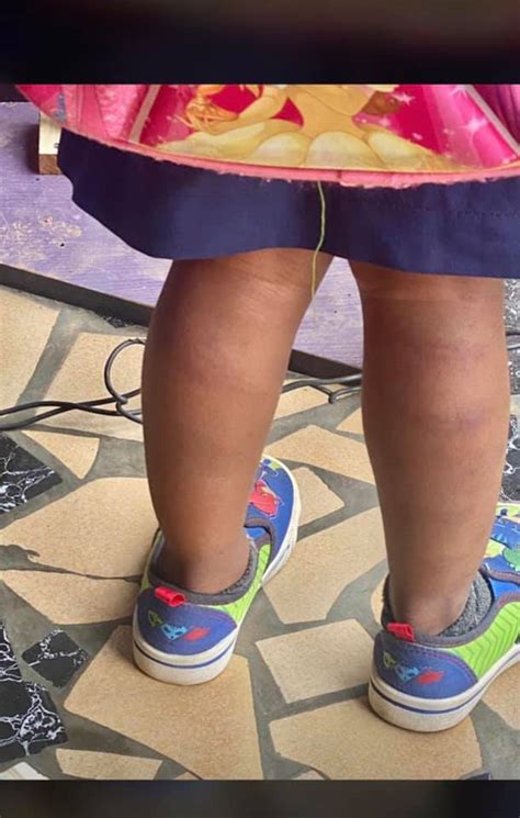 Mother Calls Out School As 3 Year Old Daughter Is Left With Cane Marks