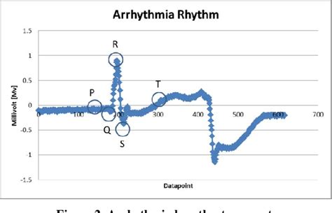 Figure 1 From Early Abnormal Heartbeat Multistage Classification By Using Decision Tree And K