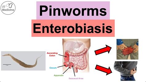 Pinworms Enterobiasis Infection Transmission Symptoms Diagnosis Treatment Youtube