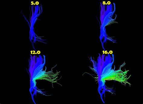 Dti教程10 种子点法皮质脊髓束纤维束成像 Dti 3dslicer中文论坛