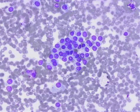 Figure S2 Findings In Diff Quik Stain In Case 1 400× Bronchial