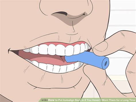 How To Put Invisalign Back In If You Havent Worn Them For A Long Time
