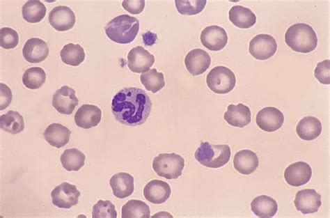 Hyposegmented Neutrophils