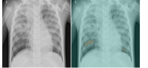 Github Ronalddaspneumonia Detection