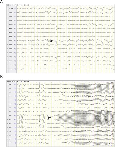 A Interictal Left Frontal Spikes Arrow B Ictal Eeg Left Frontal Download Scientific