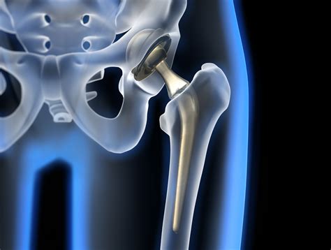 Metal On Metal Hip Replacement Claims Medical Law