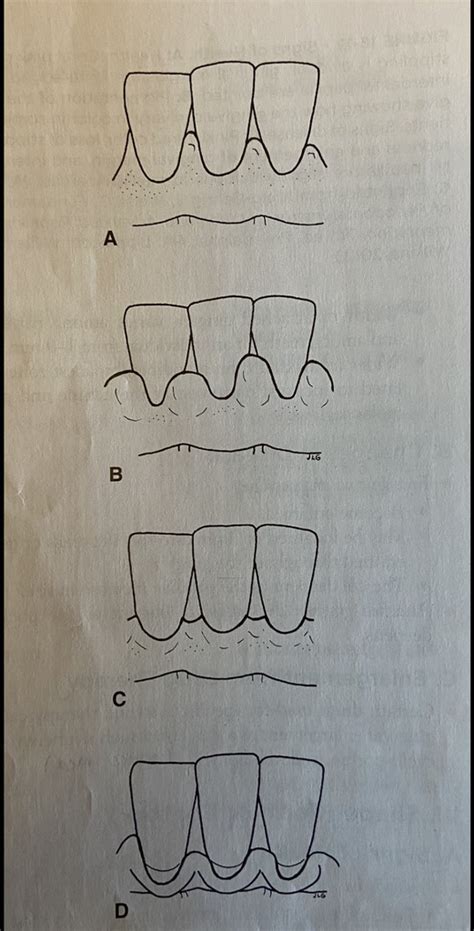 Gingival Shape Or Contour Diagram Quizlet