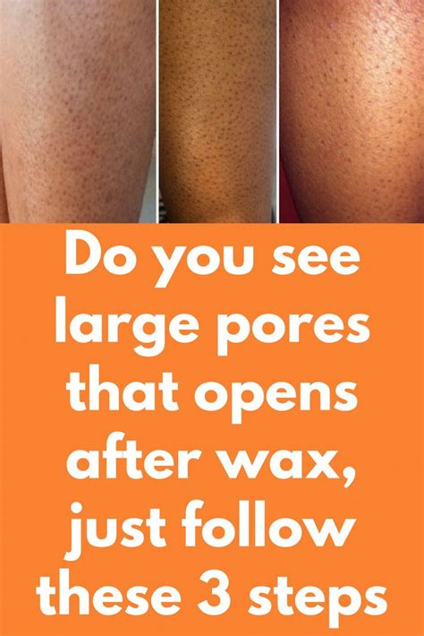 Do You See Large Pores That Opens After Wax Just Follow These Steps It Is Very Common To See