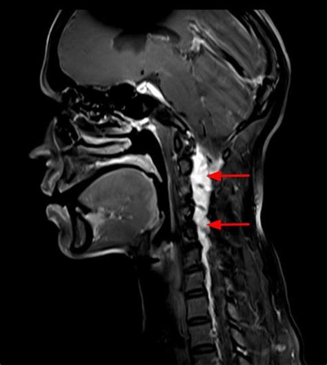 Uncovering Dural Thickening A Rare Chronic Inflammatory Condition Of The Spinal Dura Eurorad