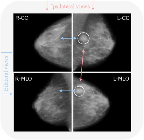 Figure 1 From Multi View Hypercomplex Learning For Breast Cancer Screening Semantic Scholar
