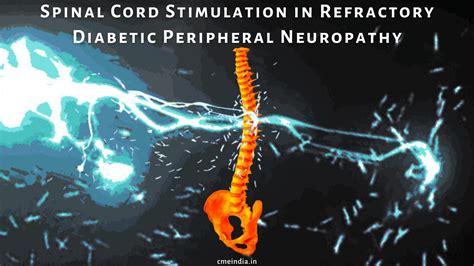 Spinal Cord Stimulation In Refractory Diabetic Peripheral Neuropathy